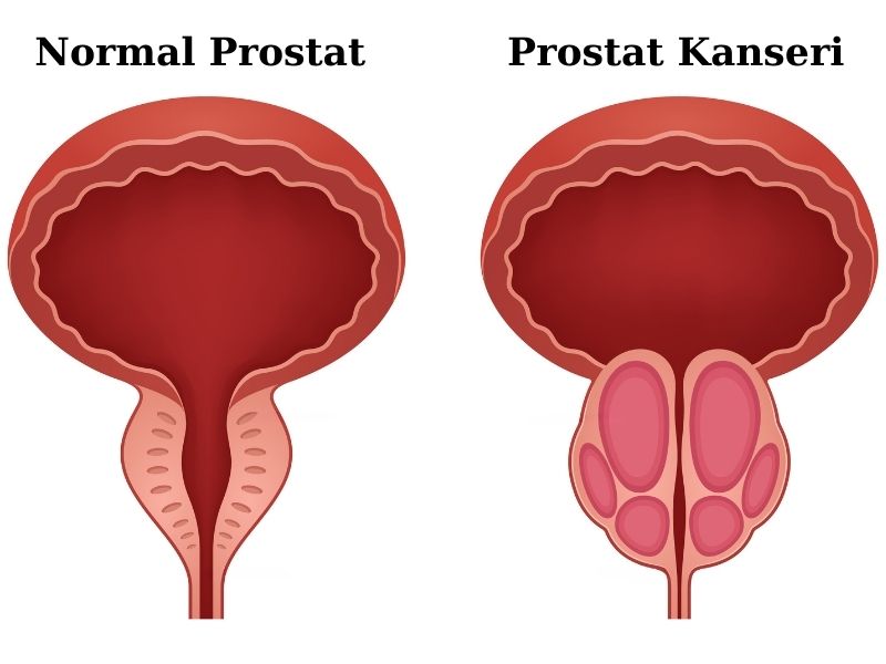 Prostat Kanseri - Üroloji Uzmanı